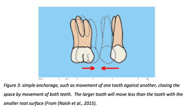 Discuss the Significant of Anchorage in Orthodontics | Smileworks