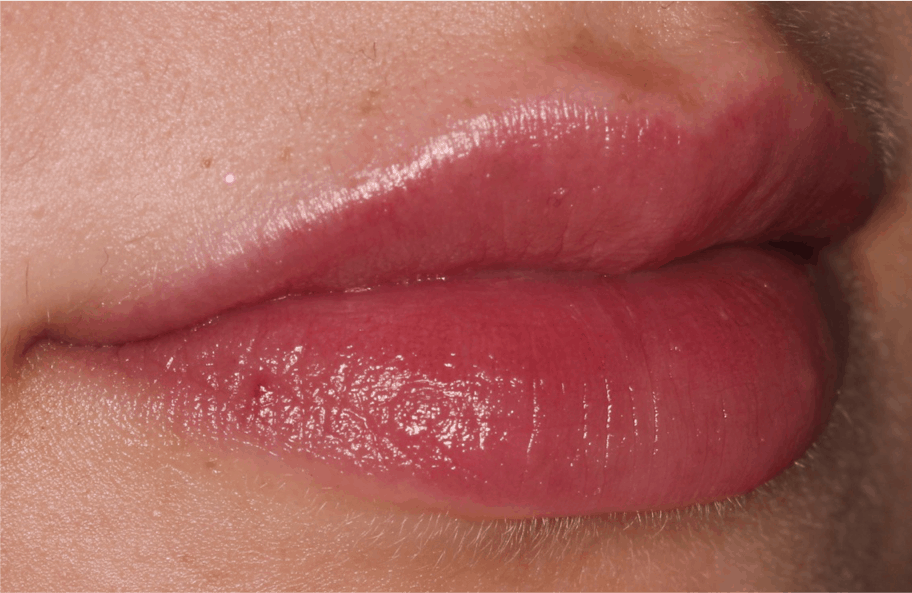Lip Fillers Liverpool | Full, Plump and Natural Lips from just £220