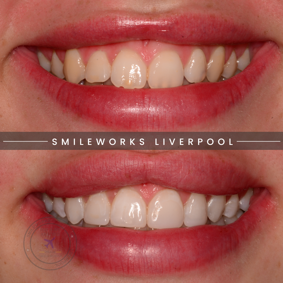 Teeth Whitening Liverpool | Beautiful, Bright and Responsible