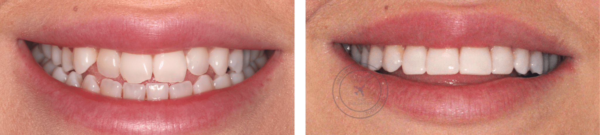 Teeth Whitening Liverpool | Beautiful, Bright and Responsible