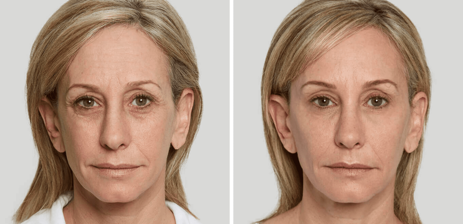 Sculptra Treatment UK | £450 per vial | Smileworks Liverpool