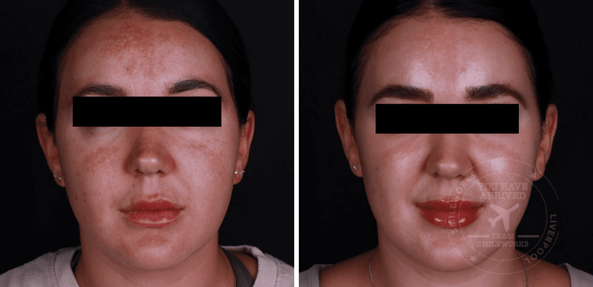 Fast & Effective Melasma Treatment | Smileworks Liverpool
