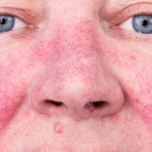 Rosacea Treatment Liverpool | Expertly Manage Facial Redness