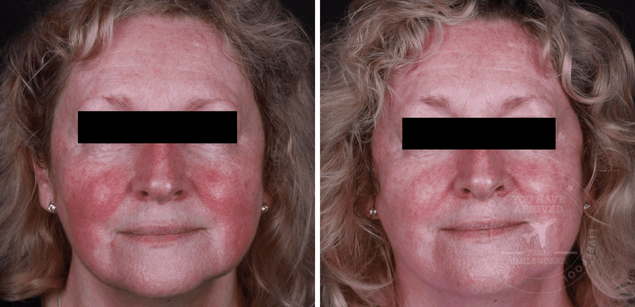Rosacea Treatment Liverpool | Expertly Manage Facial Redness